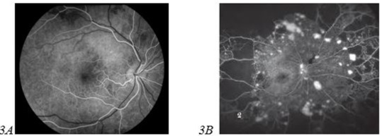 Diagnosing diabetic retinopathy from retinal imaging - Information ...